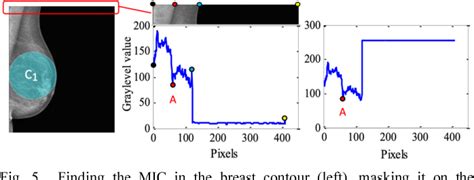 Figure 5 From Geometry Based Pectoral Muscle Segmentation From Mlo