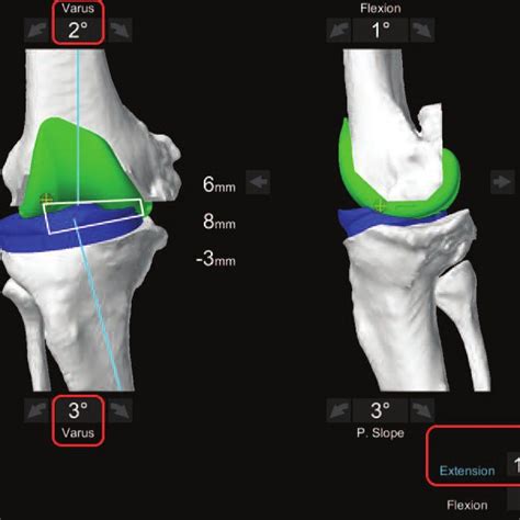 The Tibial Resection Was Reduced By 4mm And Distal Femoral Resection