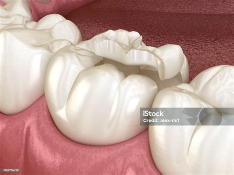 치아에 세라믹 크라운 고정 레이 인간의 치아 치료의 의학적으로 정확한 3d 그림 금이 간에 대한 스톡 사진 및 기타 이미지 금이 간 도예 디지털 생성 이미지 Istock