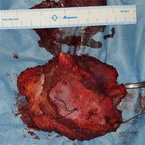 Excised Specimen With 2 Cm Margin With Lower Ribs Partial Excision