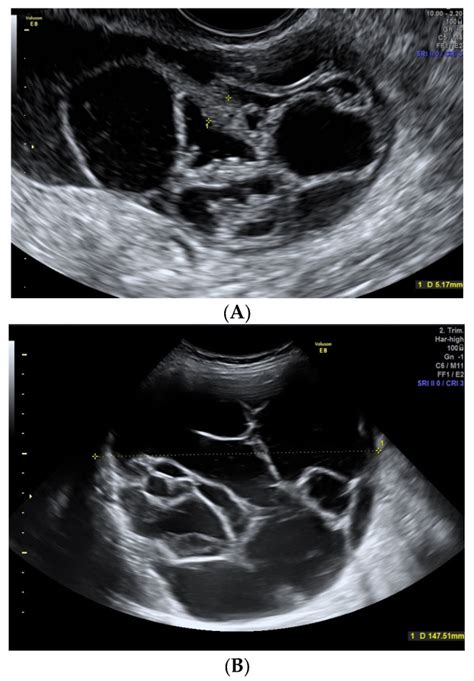 Ultrasound Features And Ultrasound Scores In The Differentiation