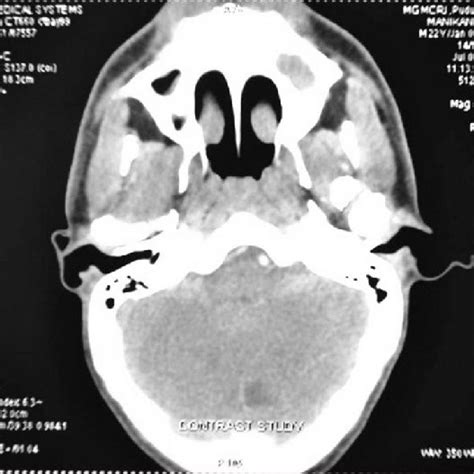 Ct Axial Section Shows Well Defined Hyperdense Mass In The Left Tmj Download Scientific Diagram