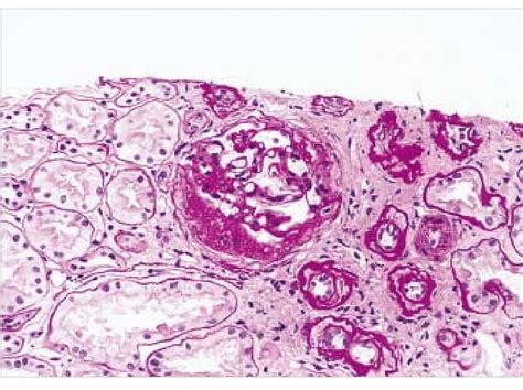 This Glomerulus Shows Segmental Sclerosis Pas Stain × 200 Download Scientific Diagram