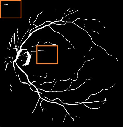 The Detected Retinal Vascular Structures By Using Different Enhancement Download Scientific