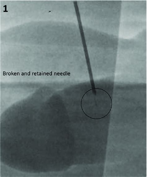 Successful Localization Of The Needle Via Intraoperative Fluoroscopic Download Scientific
