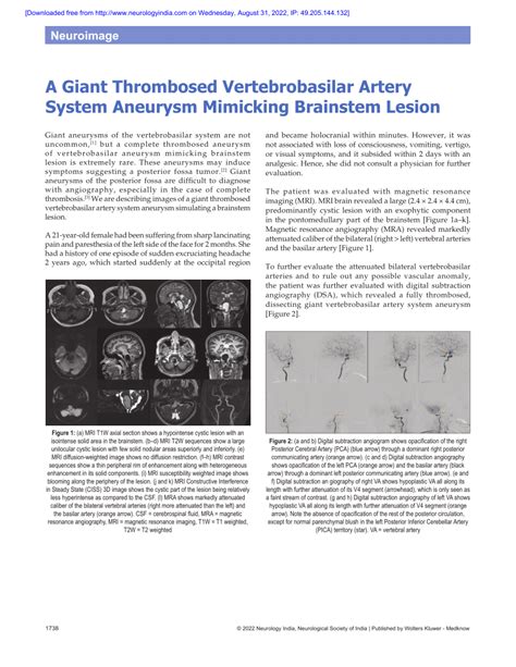Pdf A Giant Thrombosed Vertebrobasilar Artery System Aneurysm Mimicking Brainstem Lesion