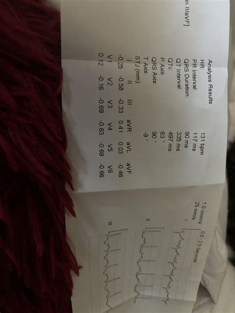 Ekg Interpretation Possible Ischemia Raskdoctorsmeeee