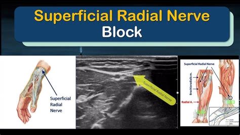 Radial Nerve Wrist Entrapment Syndromes Of The Radial Nerve