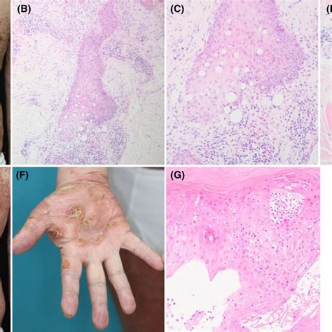 A Disseminated Pruritic Red‐to‐brown Papules On The Trunk B‐d