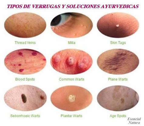 Tipos De Verrugas Y Soluciones Ayurvedicas Doğal Kozmetik Kuru Cilt