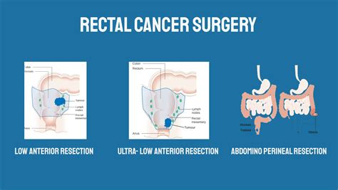 Rectal Cancer Treatment And Surgery In Delhi India Dr Nikhil Agrawal
