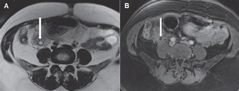 A Axial T2 Weighted Image Shows A Rounded Hyperintense Structure