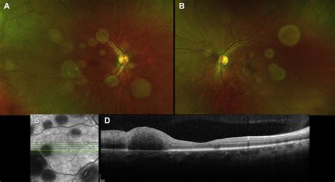 Bilateral Asymptomatic Cryptococcal Retinitis Without Choroiditis Or