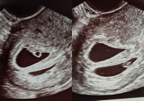 T Sign In Twin Pregnancy Seen In The Twin Peak Sign Also Known As
