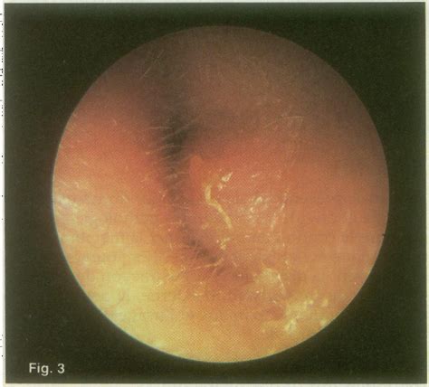 Figure 1 From A Mini Atlas Of Ear Drum Pathology Semantic Scholar
