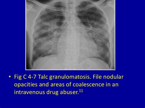 4 Diffuse Reticular Or Reticulonodular Pattern
