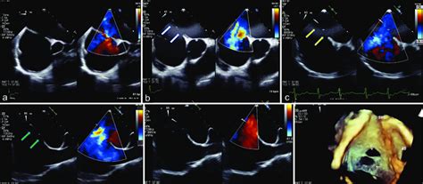 Transesophageal Echocardiogram Of The Patient 7 In Different Views Download Scientific Diagram