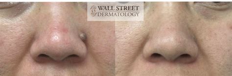 Mole Removal In New York City 150 5 Star Reviews