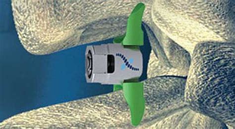 Dr Richard Gayles Superion Indirect Decompression System Is Safe