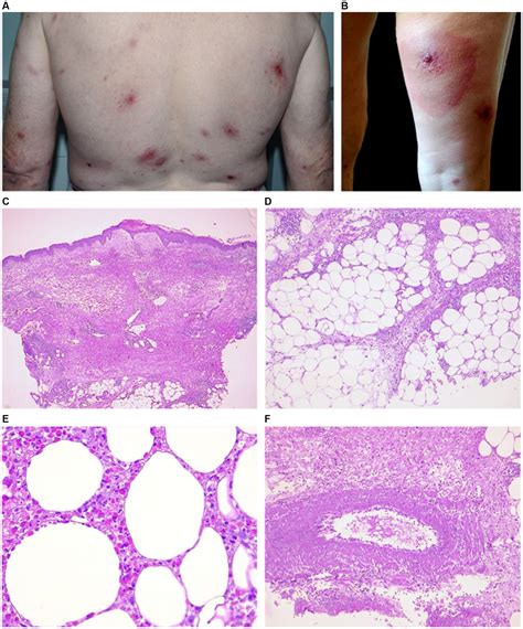Frontiers Eosinophilic Dermatosis Of Hematologic Malignancy In