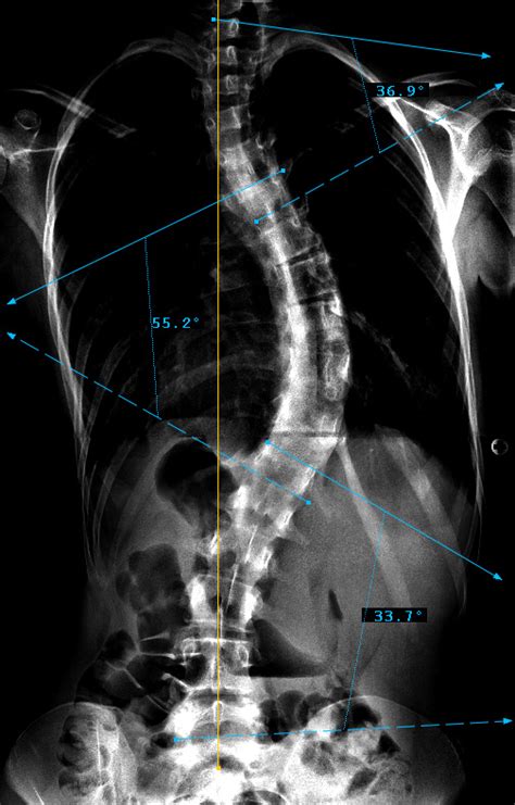 Lenke Class 2a Harms Study Group