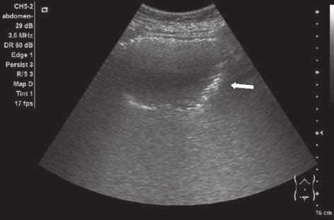 A Transverse Ultrasound View Showing Irregular Thickened Urinary