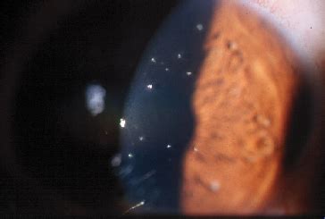 Thygesons Superficial Punctate Keratitis