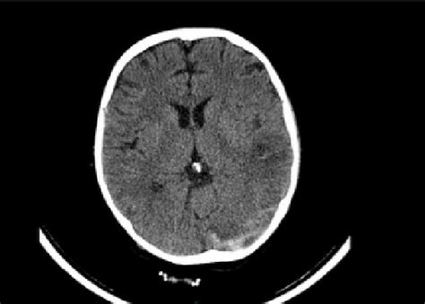 Picture Of The Left Transverse Sinus Thrombosis Associated With Left Download Scientific