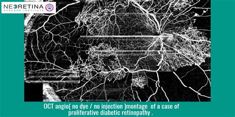 Oct Angiono Dye No Injection Montage Of A Case Of Proliferative Diabetic Retinopathy