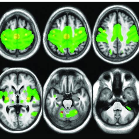 Calculation Of Functional Connectivity Between Averaged Sensorimotor Download Scientific