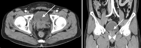 The Midline Prostatic Cyst Is Positioned Intravesically And Anteriorly Download Scientific