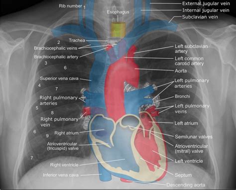 Systematic Approach To Reading Cxr And Hidden Pneumonias — Maimonides