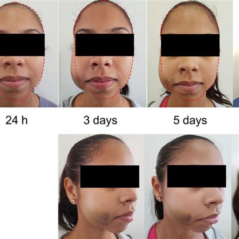 Pdf Edema And Hematoma After Local Anesthesia Via Posterior Superior