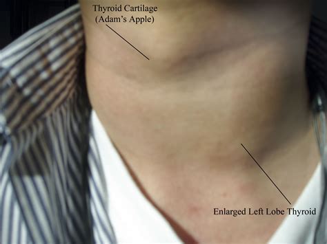 Enlarged Thyroid