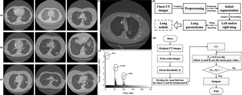 Lung Parenchyma Segmentation Typical Categories For Pulmonary Nodules Download Scientific
