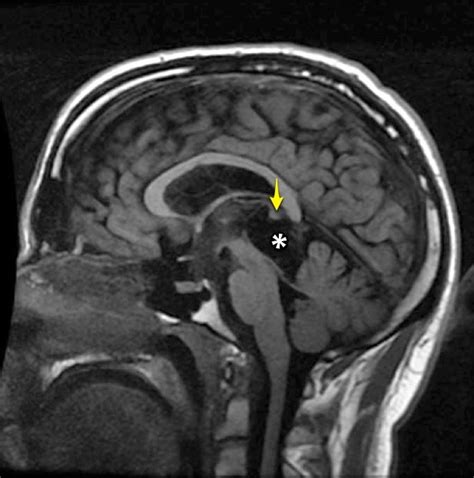Quadrigeminal Cistern Mri Intracranial Epidermoid Cyst Wikipedia