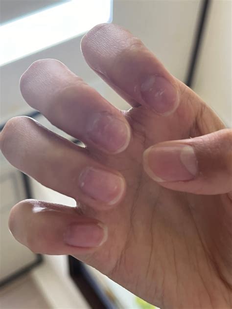 손톱에 흰색 지렁이를 없애고싶어욤 ㅜㅜㅜㅜ 지식in