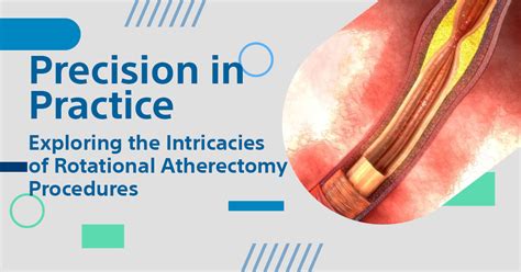 Precision In Practice Exploring The Intricacies Of Rotational Atherectomy Procedures