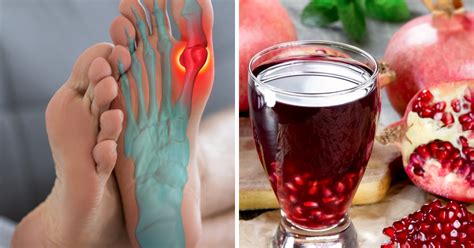 Uric Acid Symptoms And Cure Archives Presswire