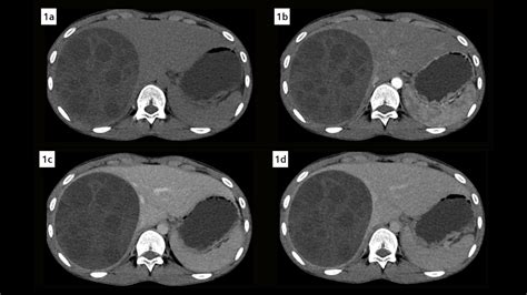 Echinococcosis Ct Hydatid Disease A Pictorial Review Of Uncommon
