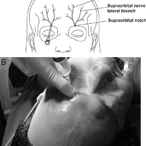 Supraorbital Nerve Block A Diagram Of Supraorbital Nerve Block Download Scientific Diagram