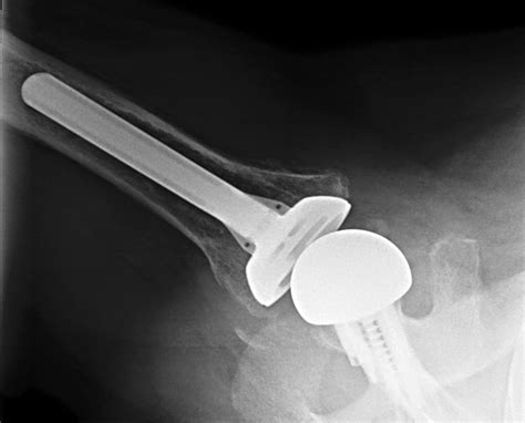 Uw Shoulder And Elbow Academy Reverse Total Shoulder Choosing A