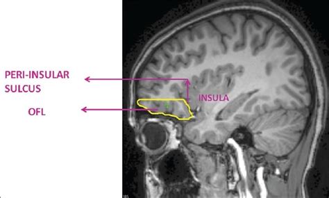 Anatomical Landmarks Of Orbitofrontal Lobe Ofl In Lateral Sagittal