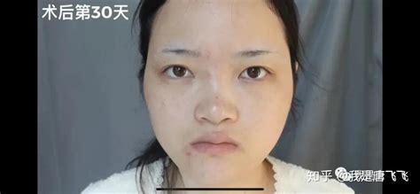 我去做超皮秒了，手术过程和30天恢复记录分享【整容】【医美】 知乎