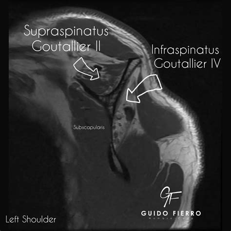 The Goutallier Classification Cirugía De Hombro Y Codo