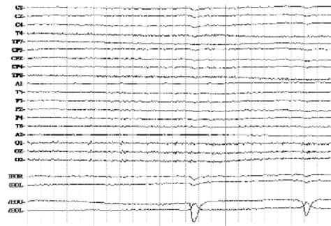 An Example Of EEG Signals Download Scientific Diagram