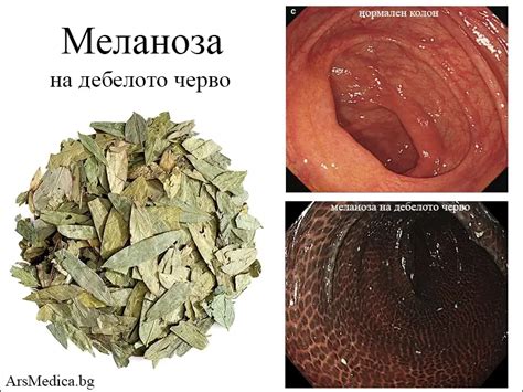 Ксизал Xyzal мощен антихистамин Arsmedica Bg