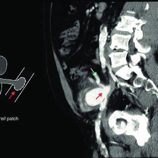 Renal Allograft Anastomotic Pseudoaneurysm Originating In The Carrel