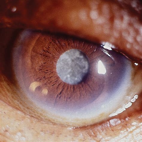 Cloudy Skies Ahead Understanding And Overcoming Cataracts Fillmore