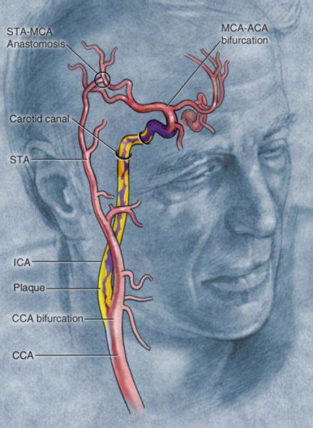 What Is Sta To Mca Bypass Surgery Barrow Neurological Institute